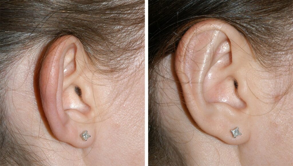 How Much Does Otoplasty Cost?