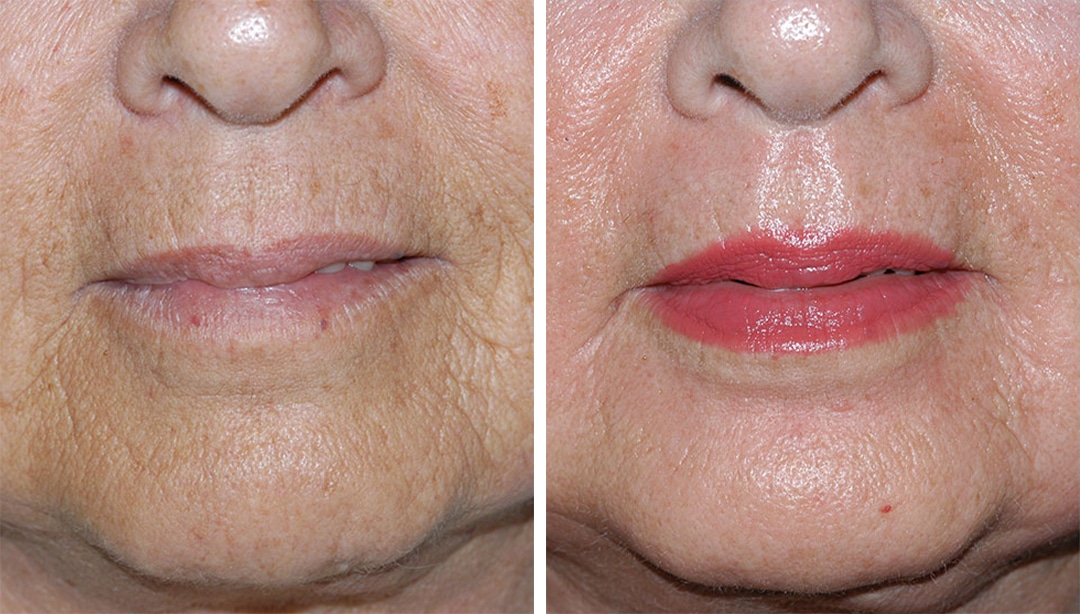 RF Microneedling