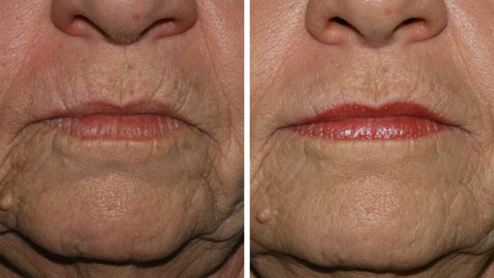 Filler treatment to improve lip volume and shape. After treatment, lips ...