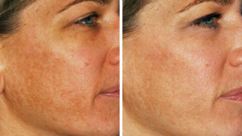 Acne scars or hyperpigmentation?