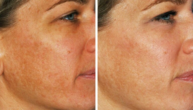 Acne scars or hyperpigmentation?