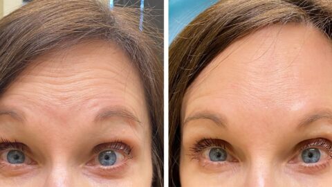 Who is a Good Candidate for Face Slimming Botox?