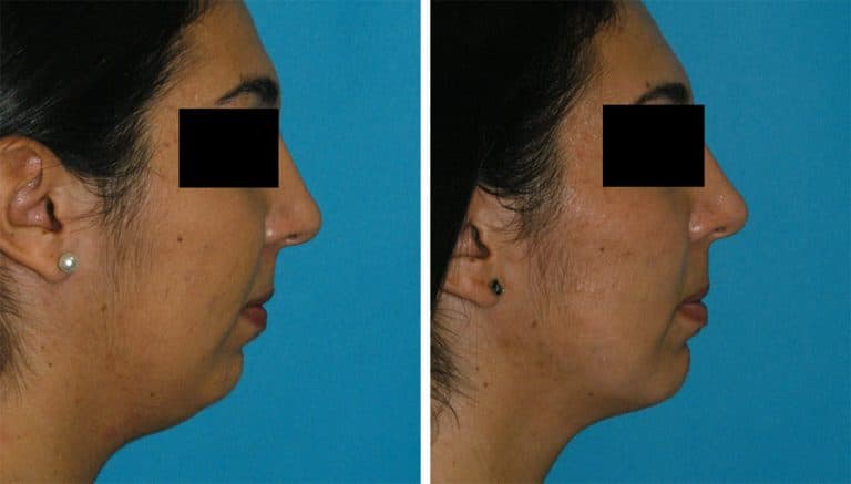 Smart Lipo to Remove Fat Under the Chin and Neck. Disclaimer: Results ...