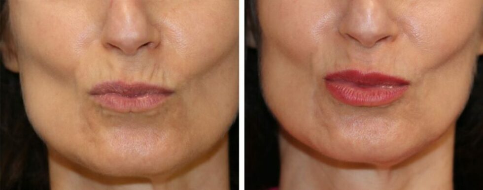 4 best ways to get rid of smokers’ lines