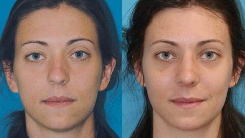 How to fix an asymmetrical face naturally without surgery?