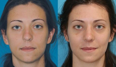 How to fix an asymmetrical face naturally without surgery?