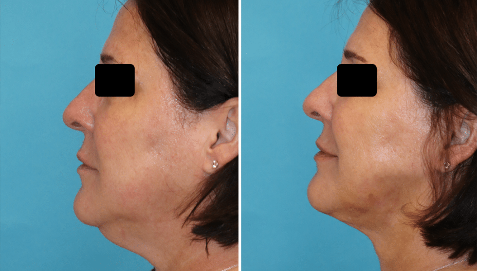 How is Smartlipo performed?