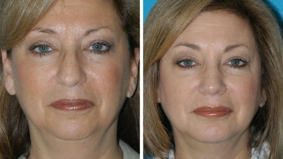 Benefits of rhinoplasty: