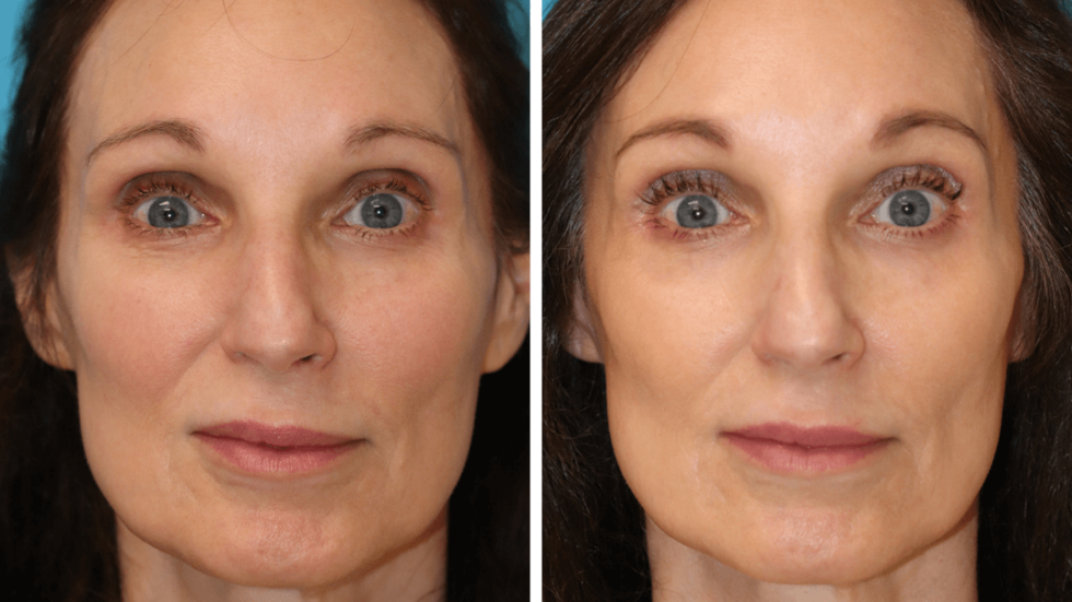 Schedule EZ PRF Gel Treatment in Princeton