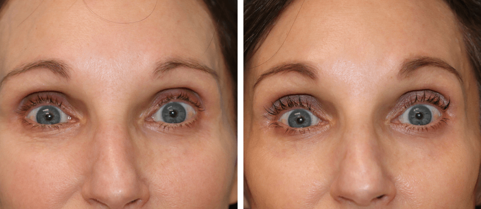 EZ PRF Gel is a three-step process that includes the following: